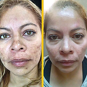 Pure Pigmentation Cream, Derm by Erica for Melasma