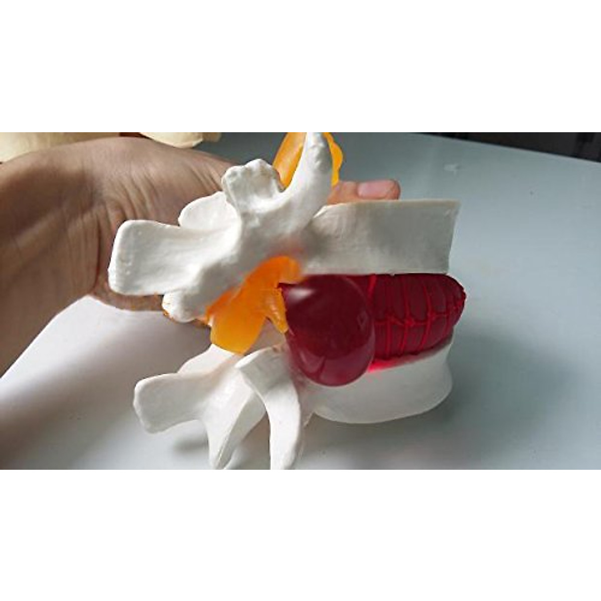 New 2pcs Anatomical Human Lumbar Vertebrae Degenerative Lumbar disc herniation demonstration model Human spine Sold by East Dental