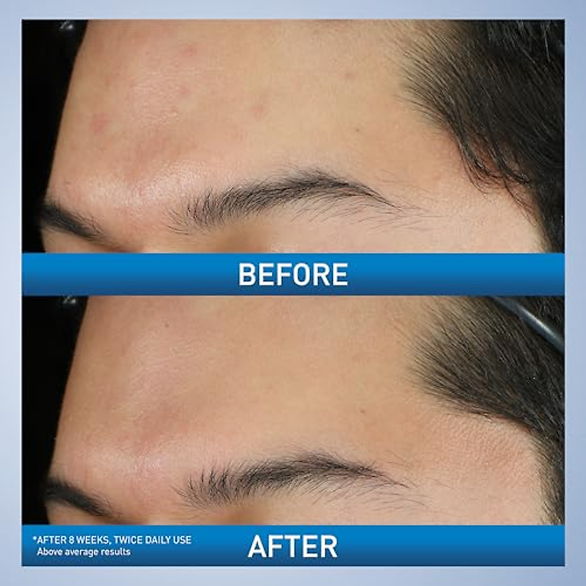 CeraVe Acne Foaming Cream Wash, Gentle Face and Body Cleanser with Benzoyl Peroxide 10%, Hyaluronic Acid, and Niacinamide, 10% Benzoyl Peroxide Treatment Clears Pimples and Blackheads 5 Oz