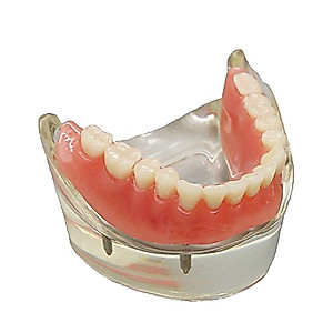 Smile1000 Dental Model Overdenture Inferior 4 Implants Demo for Teaching and Studying