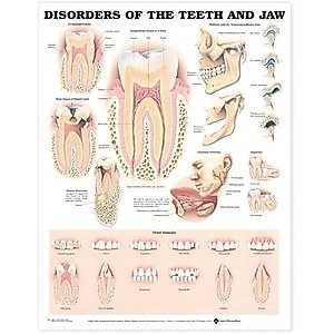 Disorders of the Teeth and Jaw Anatomical Chart