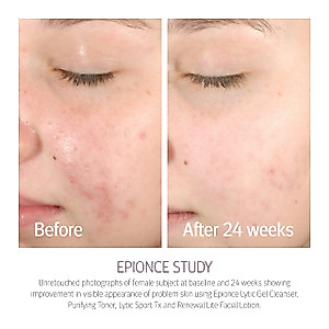 Epionce Purifying Toner - Facial & Body Toner for Problem Skin, Cleanses Dirt, Oil & Makeup with Willow Bark, Cucumber & Menthol, Dermatologist Skincare