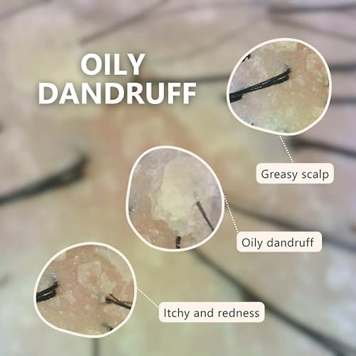 Aromase Oily Balancing Shampoo (Ideal for oily scalp with dandruff) 14 FL OZ