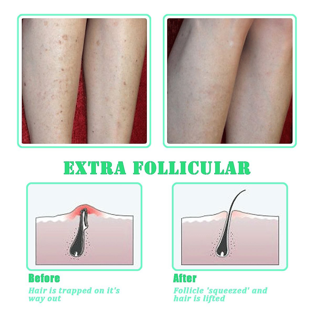 TailaiMei Exfoliating Brush for Ingrown Hair Treatment - To Treat and Prevent Bikini Bumps, Razor Bumps - Silky Smooth Skin Solution for Men and Women