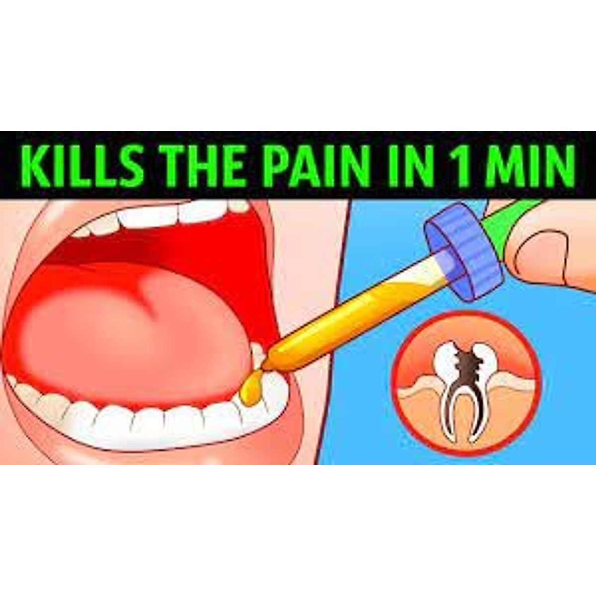 Anadent Toothache Gel, 20% Benzocaine Oral Gel for Instant Pain Relief, Oral and Toothache Medicine for Severe Pain, Fast Acting Relief of Cavity and Canker Sores, 0.25oz