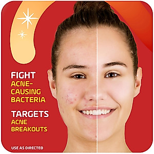 Asepxia Acne Treatment Cream for Face, 2% salicylic acid, Rapid Maximum Strength Acne Treatment, Clears Pimples and Blackheads, Prevents New Acne and Controls Excess Oil, 1 oz