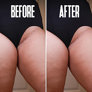 Prevent Ingrown Hairs and Razor Bumps with BHA & AHA Pads - Ingrown Hair Serum for Razor Burns - PFB Razor Bump Stopper Topicals Skin Care, Ingrown Hair Treatment for Bikini Area and Razor Bumps