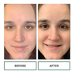 Replenix Benzoyl Peroxide Acne Gel 10% Spot Treatment