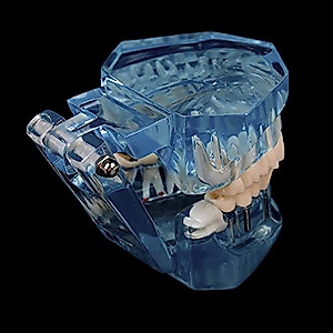 Dental Implant Model Teeth Typodont Model Dental Implant Restoration Training Tooth Pathologies Disease Demonstration Removable Teeth Teaching Studying