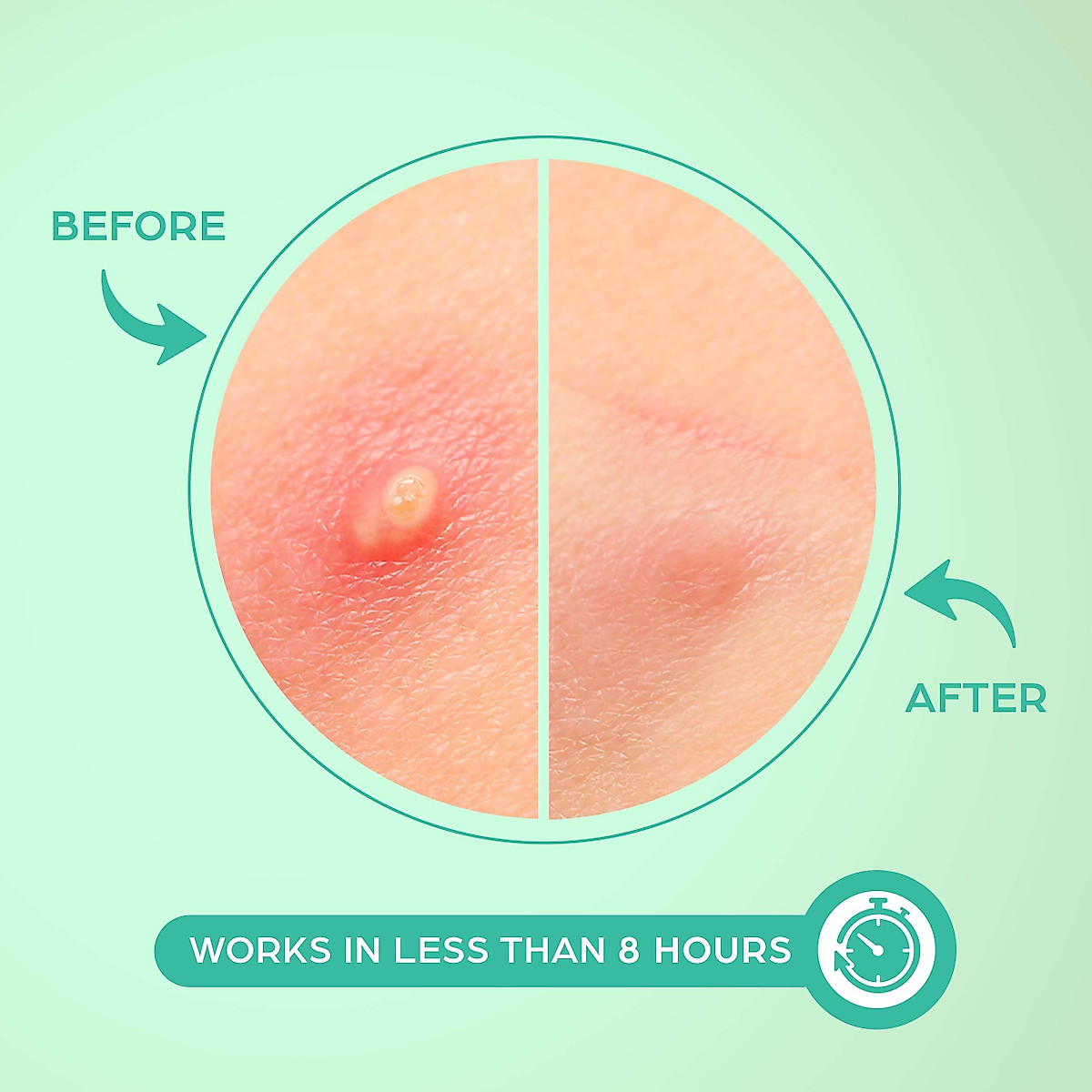 Pimple Patch Acne Treatment (Tea Tree Oil) - 120 Count, Acne-Healing Hydrocolloid Bandages (3 Sizes), Discreet Acne Dots Hydrocolloid Acne Patch, Pimple Patches, Acne Patches for Face & Body Acne