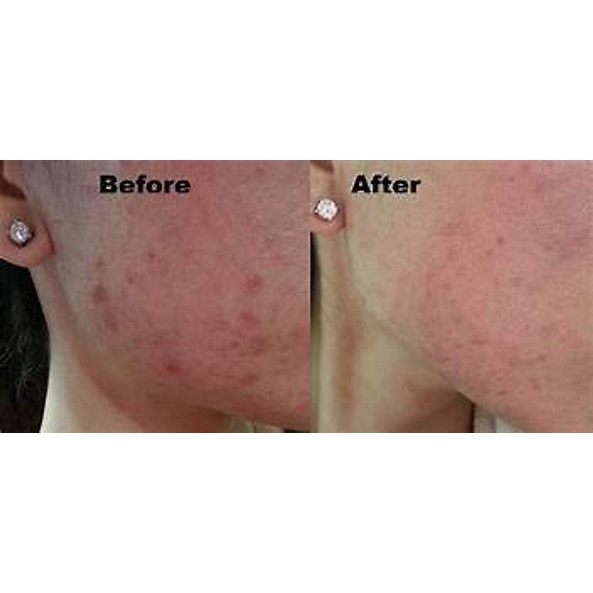 Estrogen Blocker for Men & Hormone Balance for Women- E-Block- Natural PCT Aromatase Inhibitor Anti Estrogen Acne Support Formula Post Cycle Therapy Supplement Plus DIM, Calcium-d-glucarate, Chrysin