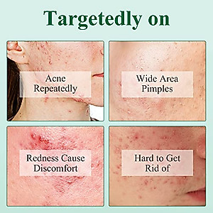 Acne Treatment Kit, Tea Tree Oil Serum & Cream,Skin Care Set for Prone Face Sensitive, Cystic Acne Pimples Scars Remover, Redness Relief, Niacinamide Facial Moisturizer, Anti Aging, Daily Prevention