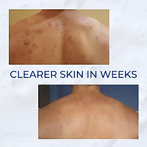 Exfoliating Facial and Body Scrub by Clear 2 Perfection, Esthetician Developed, Perfect for Bacne, Exfoliates & Clears Breakouts