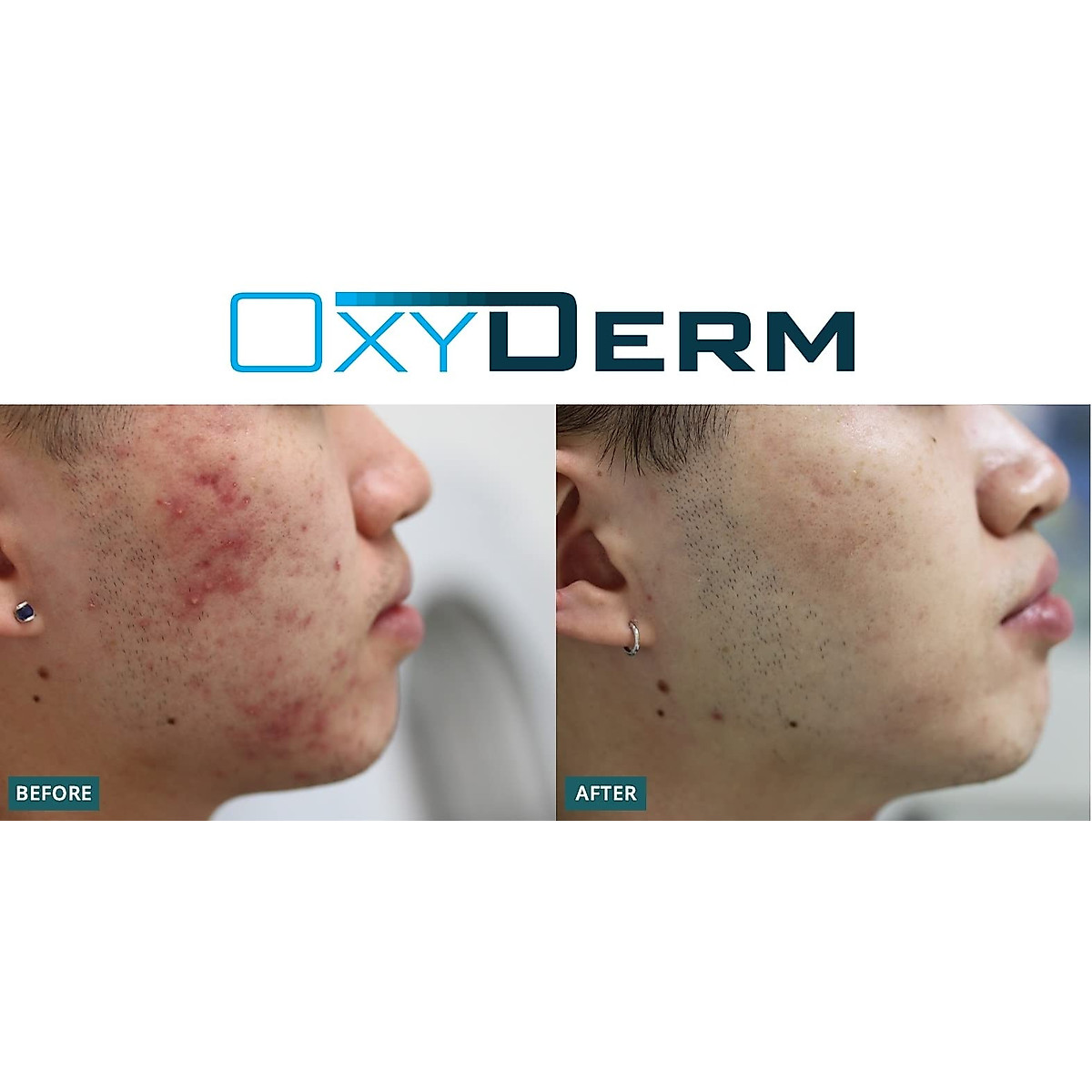 Acne Clearing Treatment Pads- Eliminates Acne Breakout Causing Bacteria. Clear Away Clogged Pores, Oily Skin, Blemish, Blackhead, Pimple, Cystic Breakouts. Contains Salicylic, Glycolic & Lactic Acid.