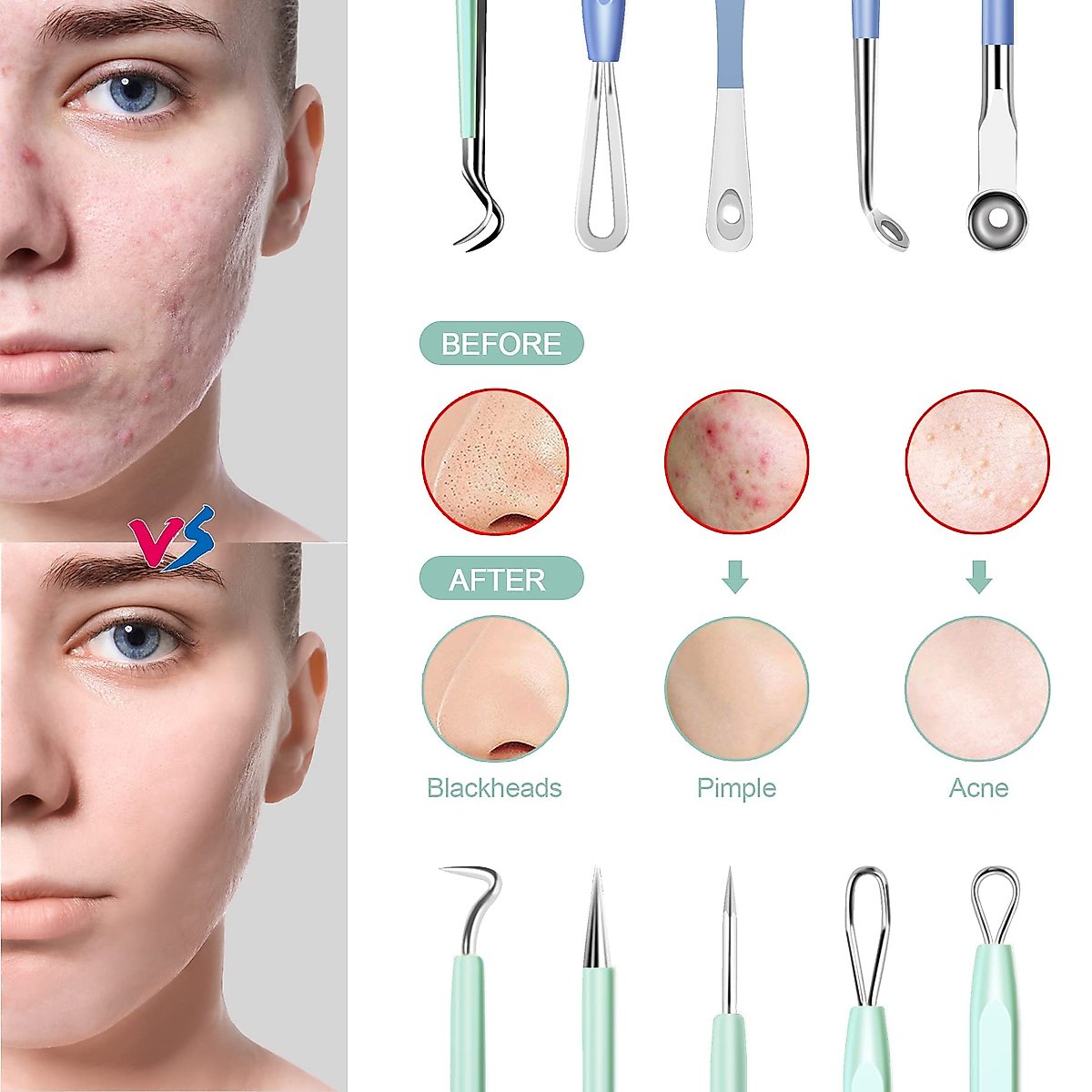 Pimple Popper Tool Kit, MENOLY 10Pcs Blackhead Remover Extractor Tools, Acne Kit for Blackhead,Blemish,Zit Removing, Whitehead Popping and Comedone Extractor Tool with Leather Bag