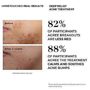 Acne Treatment Pads- Contains Salicylic, Glycolic, & Lactic Acid for Face & Body. Clears Away Clogged Pores, Oily Skin & Cystic Breakouts. Removes Dark Spots, Blackhead & Whitehead Pimples