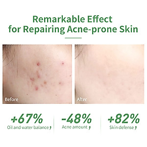 Acne Treatment Face Serum, 10% Salicylic Acid, Pimples Remover & Dead Skin Peels, Relieve Redness Rosacea Blemish, Centella Asiatica Soothing Calming, Acne Prone Sensitive Facial Skin Care, 30ml