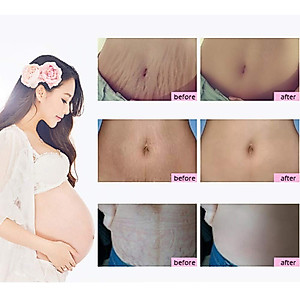 Stretch Mark Cream For Pregnancy Repair Scar Slack Line Abdomen Stretch Marks Cream, Remove Stretch Marks From Pregnancy, Repair Scar Slack Line Abdomen Stretch Marks Postpartum