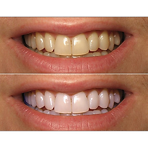 ProDental Teeth Whitening Gel Syringe Refill 10 Pack, 35% Carbamide Peroxide - 60 Treatments, Faster Results Than Tooth Whitening Strips - Pen - Powders and Toothpaste, Safe for Sensitive Teeth