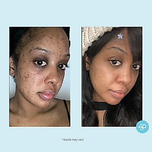 Salicylic 10% Gel Peel, Breakout and Pore Minimizer and Cleanser, 15-30 Full Facial Chemical Peels, 1 fl oz. e, 30 mL – Perfect Image