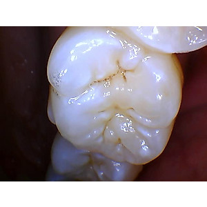 TELICAM Intraoral Camera Dental, Works with Eaglesoft, Dexis, Apeteryx, Carestream, Tigerview