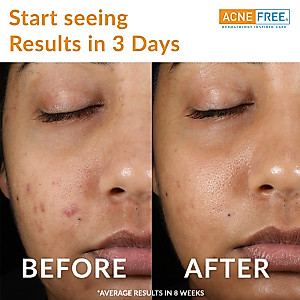 AcneFree 24 Hour Acne Clearing System 1 kit (Pack of 2)