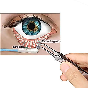 Meibomian Gland Expressor Stainless Steel Eyelid Massage Tweezers for Dryeye Extraction Tool