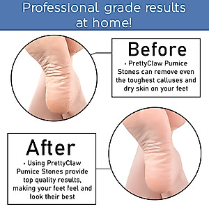 PrettyClaw 4pc Pumice Stone for Feet Callus Remover Pumice Pad Pedicure Tool Pumice Bar Removes Dead Skin Pumice Foot Scrubber Blue/Yellow (Pack of 4)