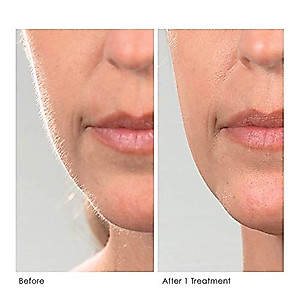 Michael Todd Sonicsmooth Replacement Kit for At-Home Dermaplaning