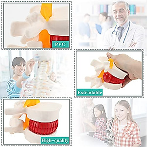 RONTEN Lumbar Disc Herniated Model, Human Anatomical Lumbar Spine Model for Medical Teaching & Learning