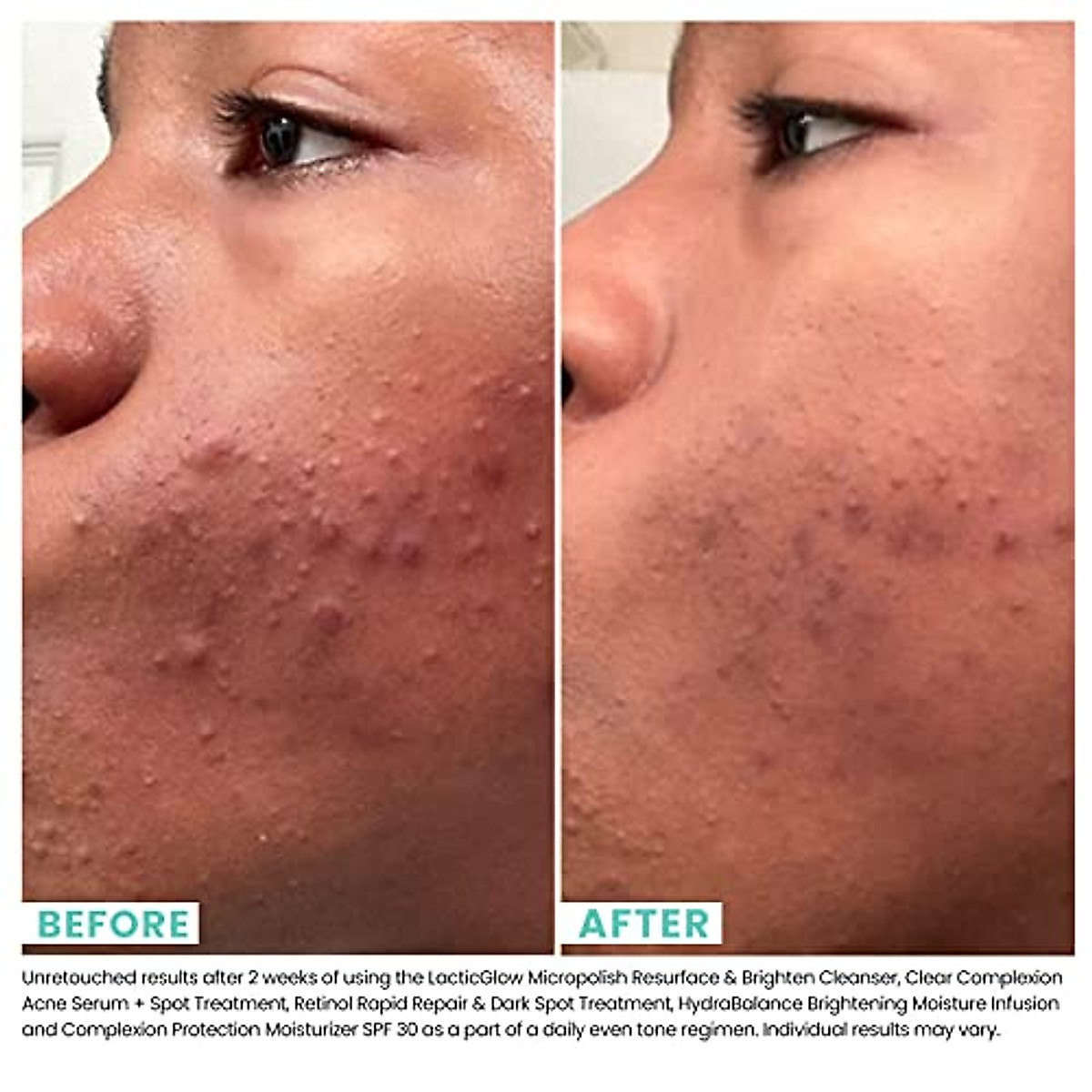 Urban Skin Rx Clear Complexion Acne Serum + Spot Treatment | Helps to Reduce + Prevent Breakouts, Improves the Look of Blemishes and Aging Skin with 5% Benzoyl Peroxide and 5% Glycolic Acid | 1 Fl Oz