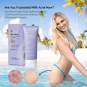 Tobcharm Back Acne Treatment, Butt Acne Clearing Treatment, Body Acne Treatment with Azelaic Acid 3.4 fl. oz., Great for Men and Women Acne Scar Treatment, Hormonal Acne And Cystic Acne Treatment