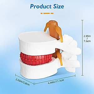 faruijie Disc Herniation Model - 1.5X Lumbar Herniated Disc Model Vertebral Spine Anatomical Medical Model