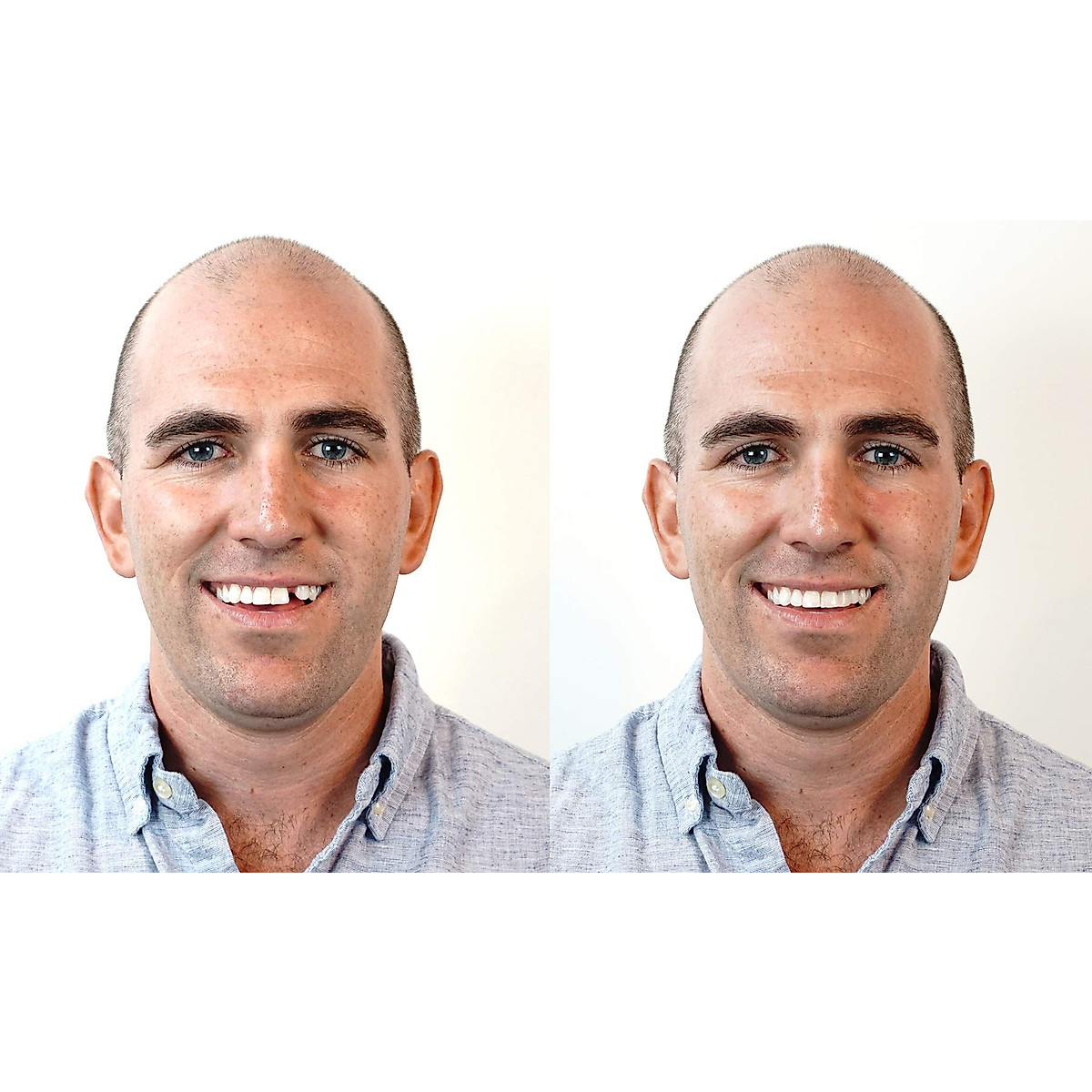 Instant Smile Triple Shade Temporary Tooth Kit - Replace A Missing Tooth in Just 5 Minutes!