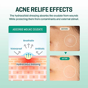 SOME BY MI 30 Days Miracle Clear Spot Patch - Pack of 1, 18 Counts, 2 Size(10mm 9Counts, 12mm 9Counts) - Invisible Hydrocolloid Skin Trouble and Pimple Patch with No Irritation - Korean Skin Care