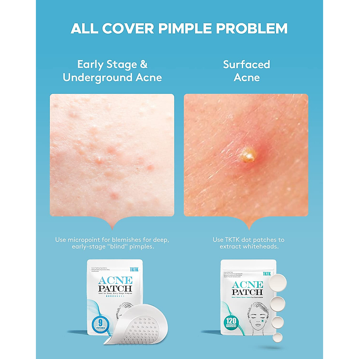 TKTK Self-Dissolving Microdart Acne Pimple Patches for Zits and Blemishes with 100% Pure Hyaluronic Acid, 4 Sizes Acne Absorbing Cover Patch, Acne Spot Treatment Stickers for Face and Skin (99 Count)