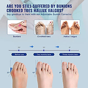 Fitgeno Bunion Corrector Women & Men Big Toe: Foot Straightener Splint Brace - Adjustable Bunyan Correction Orthopedic for Hallux Valgus Pain Relief 2 Pcs