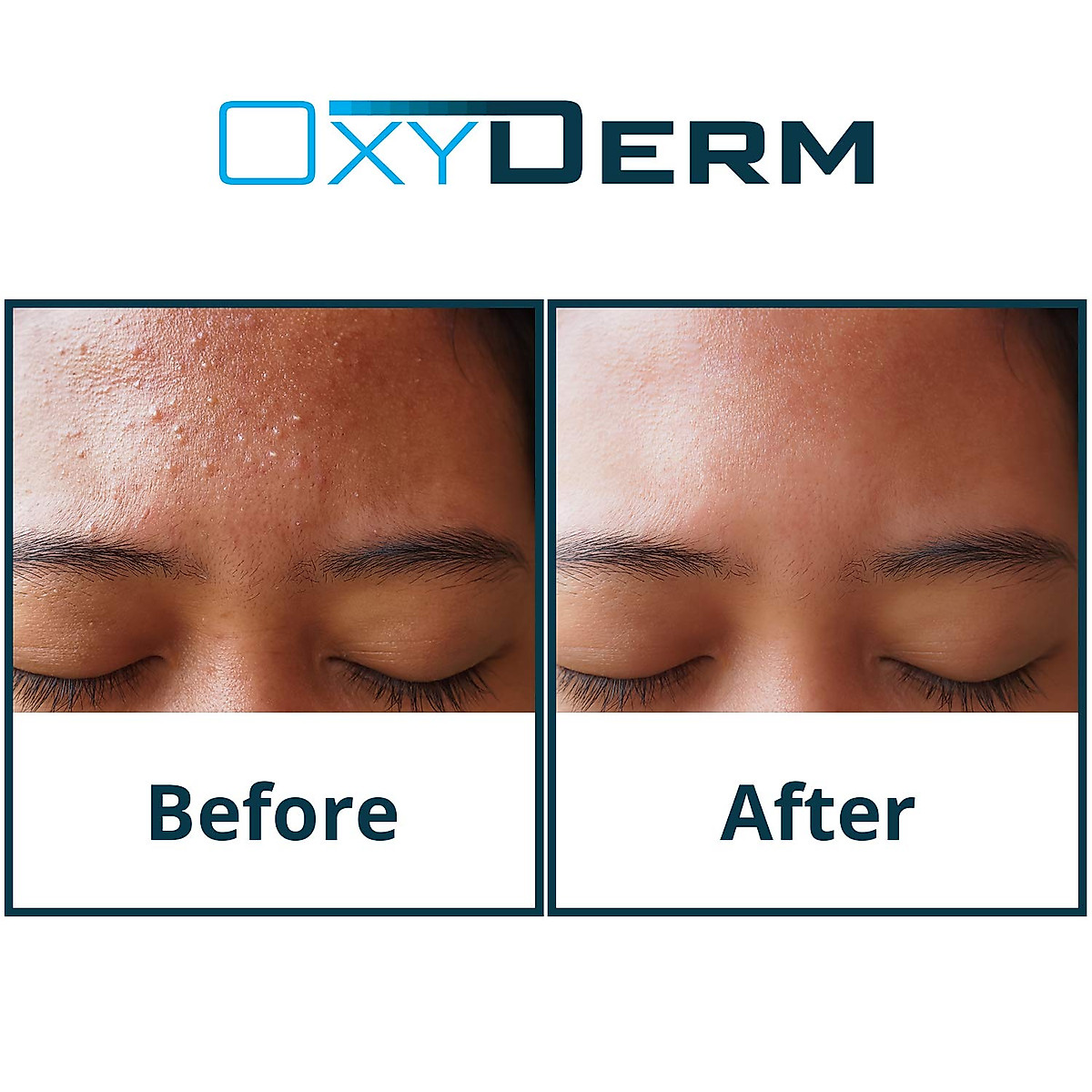 Acne Clearing Treatment Pads- Eliminates Acne Breakout Causing Bacteria. Clear Away Clogged Pores, Oily Skin, Blemish, Blackhead, Pimple, Cystic Breakouts. Contains Salicylic, Glycolic & Lactic Acid.