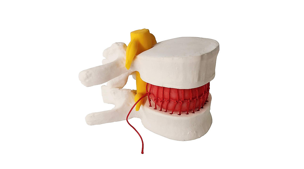 Human Herniated Disc Model for Medical Teaching and Learning