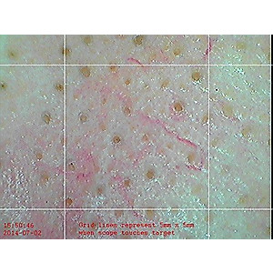 Firefly DE350 Wireless Polarizing Dermatoscope