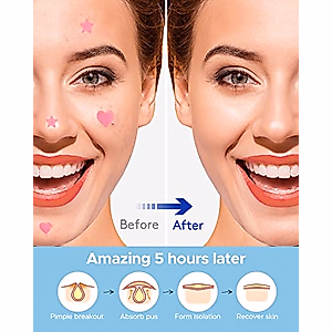 LitBear Acne Patch Pimple Patch, Pink Heart & Star Shaped Acne Absorbing Cover Patch, Hydrocolloid Acne Patches For Face Zit Patch Acne Dots, Tea Tree Oil + Centella (108 Count (Pack of 1))