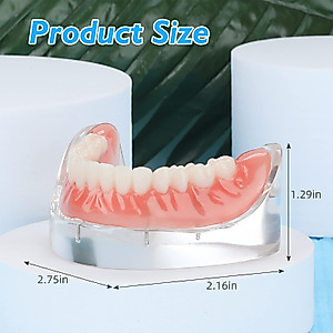 faruijie Overdenture Model - Implant Overdenture Model Lower Denture Model with Four Implants Dental Model Overdenture for Teaching and Studying