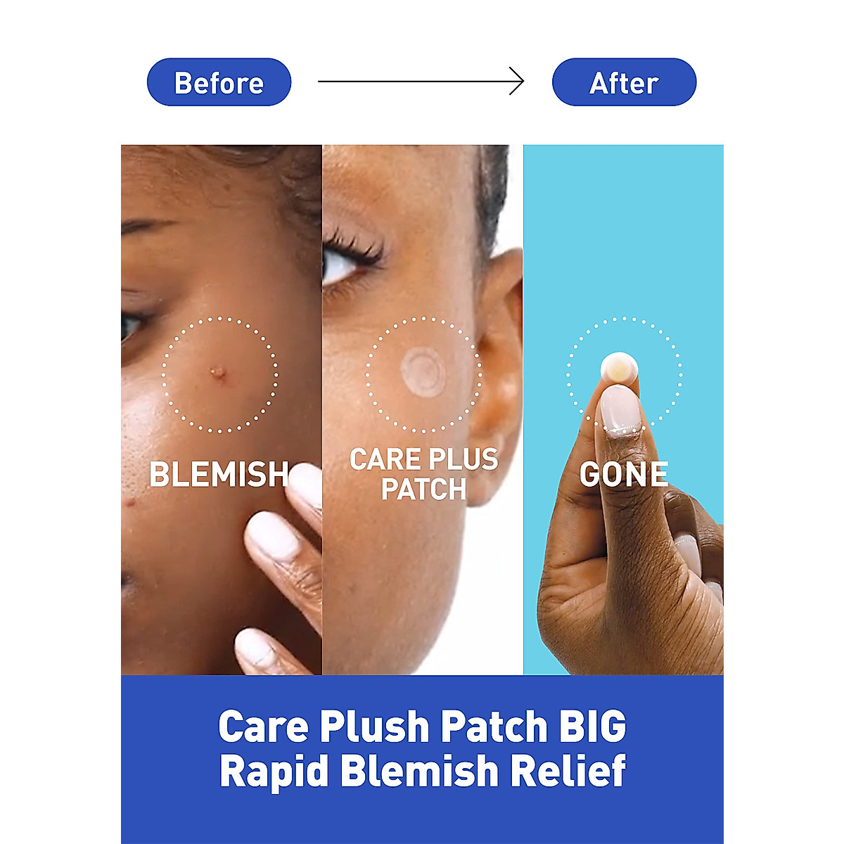 OLIVE YOUNG Care Plus Spot Patch Big (81 Count) | Hydrocolloid Patch, Spot Stickers for Acne Pimple and Zits