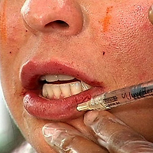 The Complete Guide to Dermal Filler Injections - Learn How To Inject Juvederm - Learn How To Inject Radiesse - This Advanced Radiesse Training Video / Juvederm Training Video Shows Injection Techniques for Medical Aesthetics Training