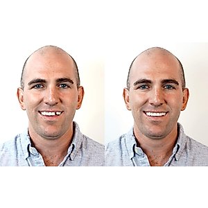Instant Smile Triple Shade Temporary Tooth Kit - Replace A Missing Tooth in Just 5 Minutes!