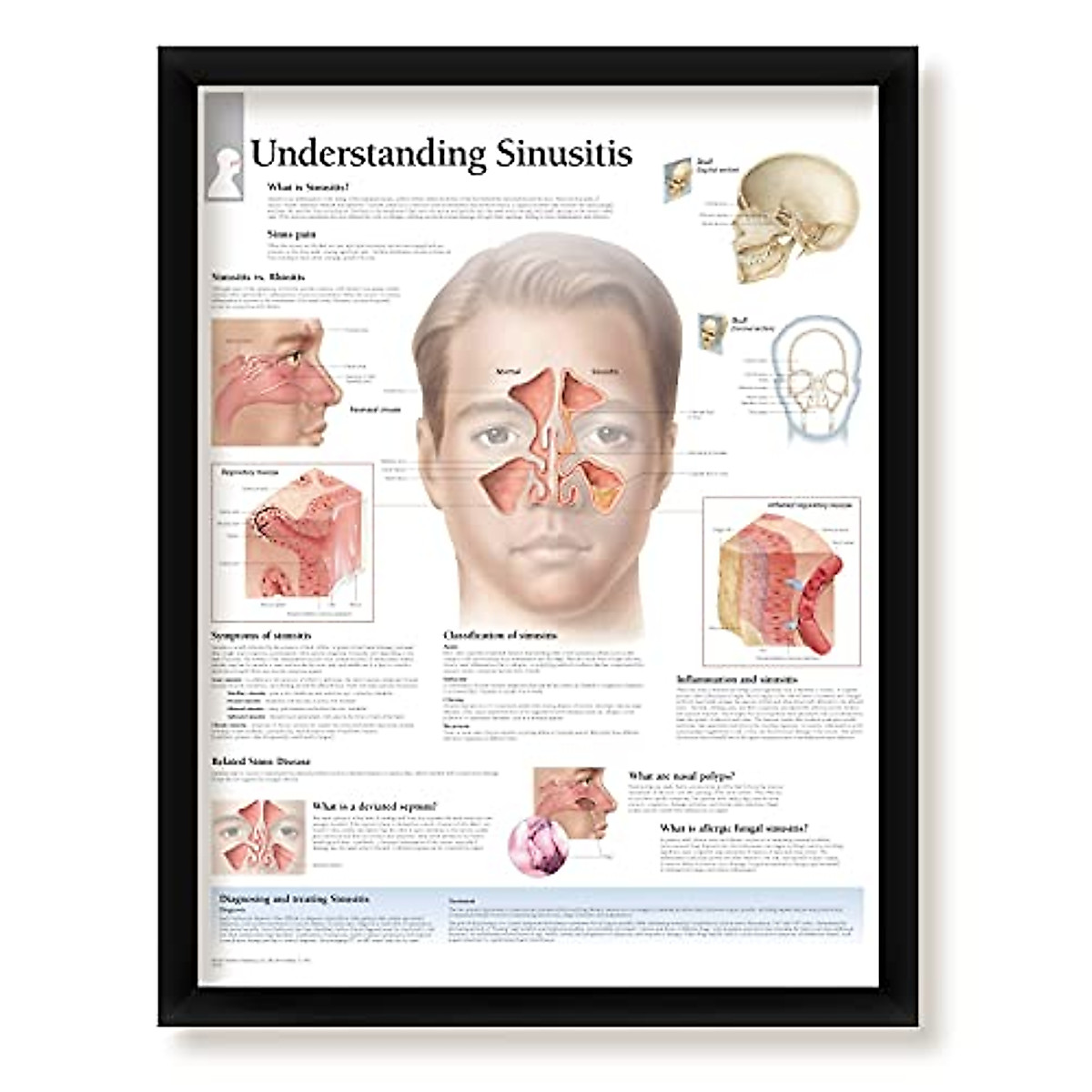 Set of 4 Framed Medical Posters Ear, Nose and Throat, Understanding Sinusitis, Understanding Rhinitis, and Middle Ear Infections 22"x28" Wall Diagrams