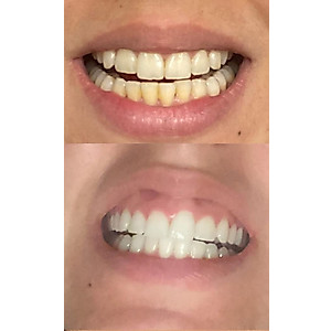 Dr Song Teeth Whitening Gel Refill 4X Syringes 35% Carbamide Peroxide