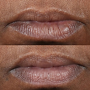 Cold Plasma Plus+ Lip Therapy