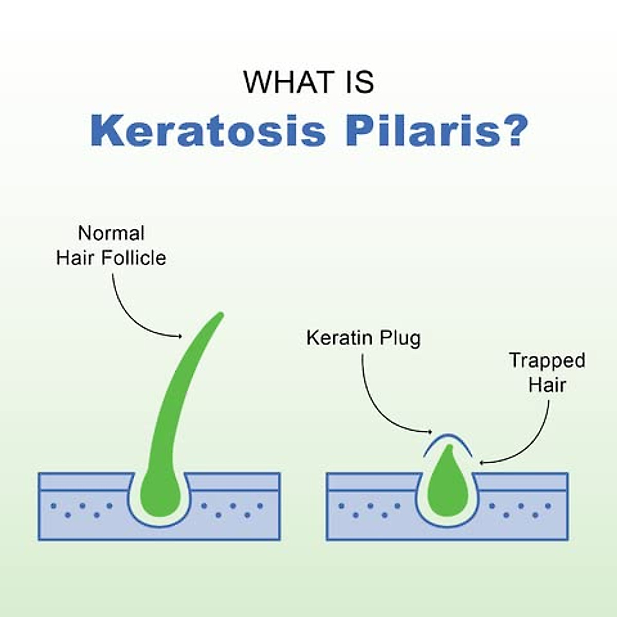 KP Elements Keratosis Pilaris Lotion (4 fl oz) - Natural Keratosis Pilaris Treatment, Moisturizing & Exfoliating AHA Lotion for KP, Vegan, Made in USA