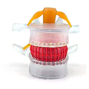 DenFactory Human 1.5 Times Life-Size Transparent Lumbar Disc Herniation Spine Model for Teaching and Learning
